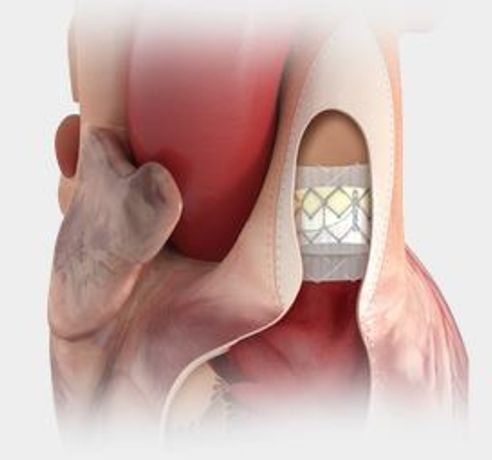 Edwards Sapien - XT - Devices - Transcatheter Heart Valves ...