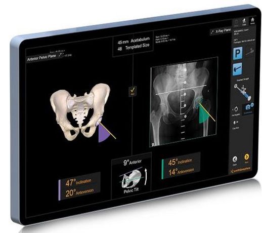 Smith-Nephew - RI.KNEE - Orthopedic Reconstruction - Real Intelligence ...