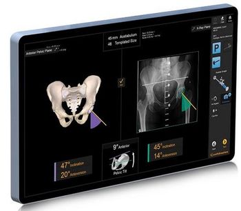 Smith-Nephew - RI.KNEE - Orthopedic Reconstruction - Real Intelligence ...