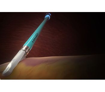 Voyant 5Mm Fusion Device