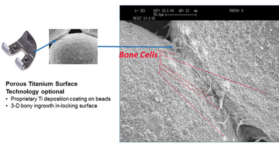 Consensus Knee System