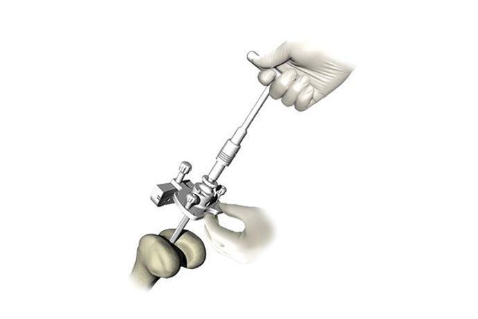 Medspark - Femoral Alignment Drill Guide By Medspark, LLC