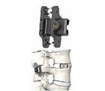 Pioneer BACFUSE Spinous Process Fusion Plate