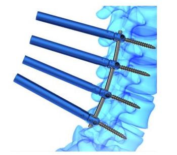 Fusepss MIS Pedicle Screw System