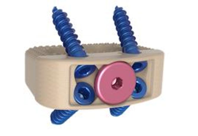 Vault - ALIF - Anterior Lumbar - Midline Screw System By ...