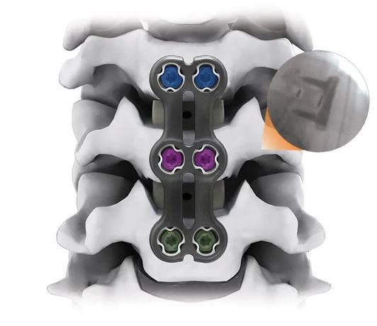 IRIS - Cervical - Anterior Cervical Plate System By Life ...