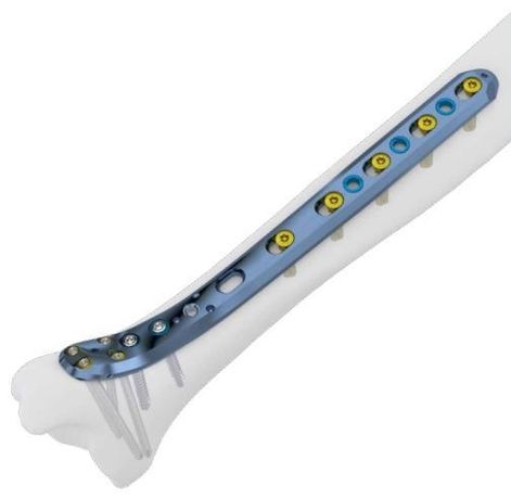 Intrauma Tibia Titanium Bridge Fixation With Angular Stability Plates