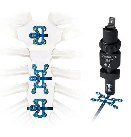 Sternalock - 360 - Sternal Closure - Sternal Rigid Fixation - Sternal ...
