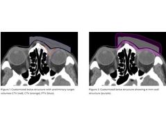 Comparison Of Flexible Silicone Bolus To 3D Printed Rigid Bolus - Case ...