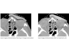 Comparison Of Flexible Silicone Bolus To 3D Printed Rigid Bolus - Case ...